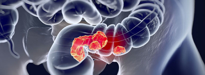 Cancer-Colorretal - Instituto Jorge Reina